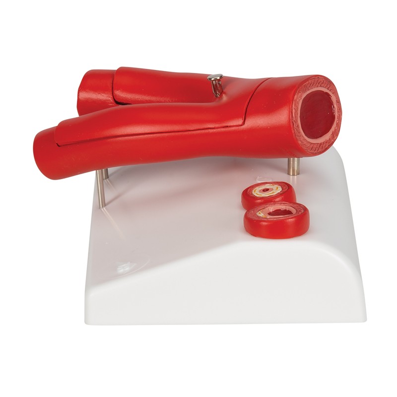 2-Part Atherosclerosis Model w/ Artery | Health and Care